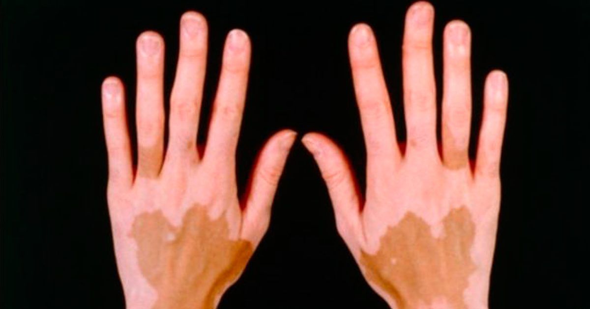 Vitíligo: enfermedad que desaparece el color de la piel - 24 Morelos