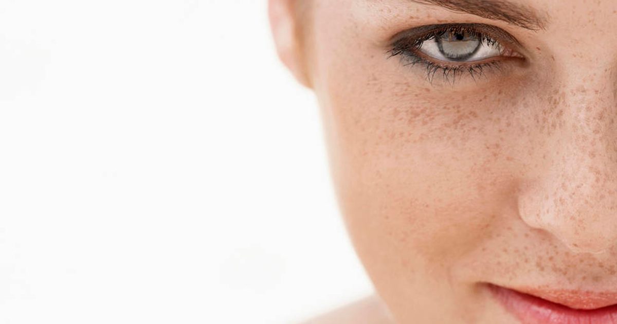Conoce qué son las pecas y cómo debes tratarlas - 24 Morelos
