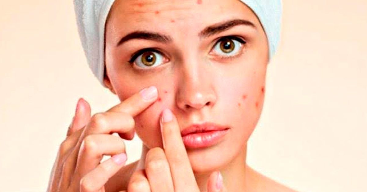 Evita explotar las imperfecciones en la piel - 24 Morelos